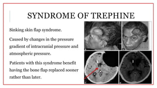 Decompressive craniectomy | PPT