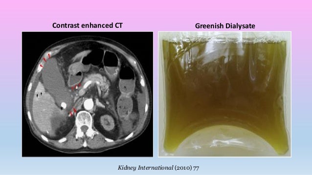 Differential Diagnosis of Cloudy effluent in Peritoneal Dialysis