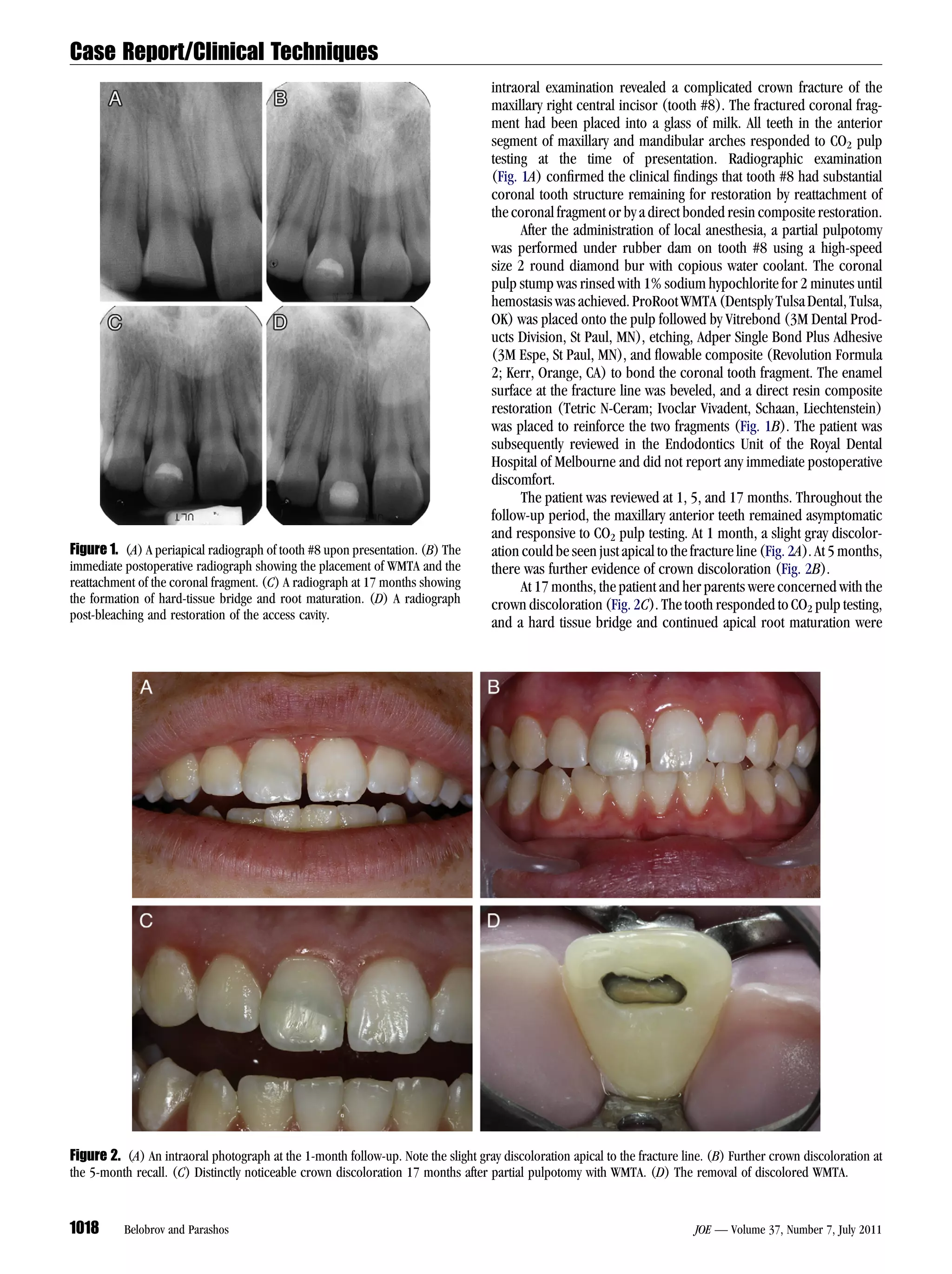 Treatment-of-tooth-discoloration-after-the-use-of-white-mineral ...