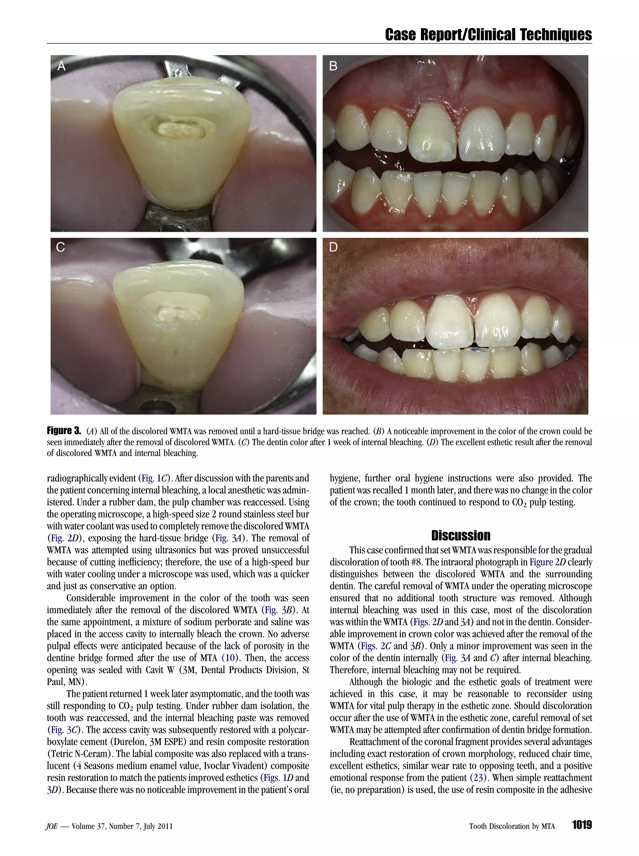 Treatment-of-tooth-discoloration-after-the-use-of-white-mineral ...