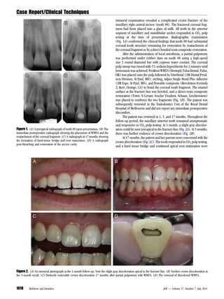 Treatment-of-tooth-discoloration-after-the-use-of-white-mineral ...