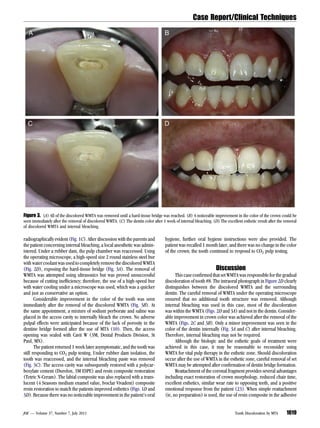 Treatment-of-tooth-discoloration-after-the-use-of-white-mineral ...