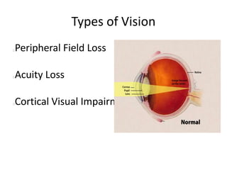 Visual Impairment and Motor Development | PPTX