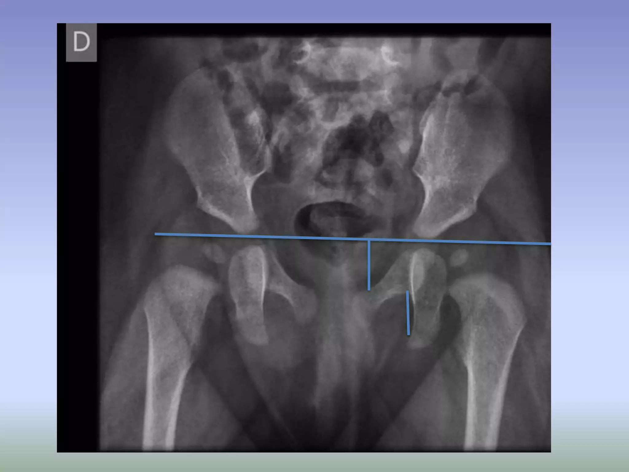 Displasia del desarrollo de las caderas | PPTX