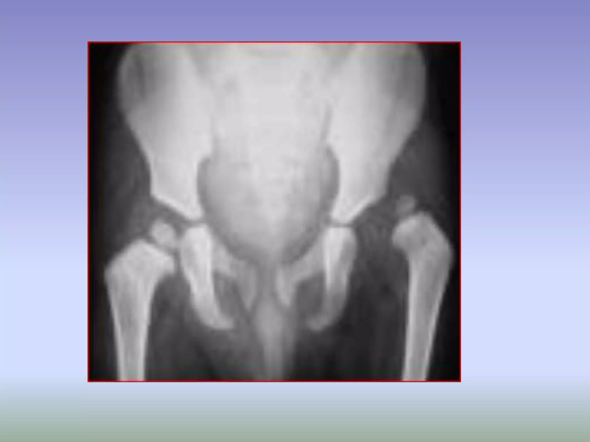Displasia del desarrollo de las caderas | PPTX