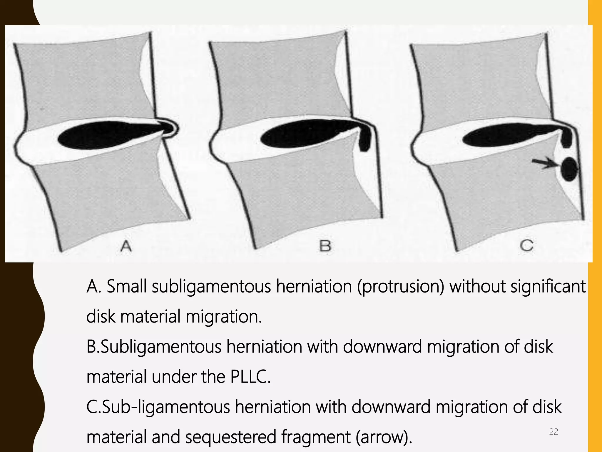 Degenerative disc disease (DDD) | PPTX