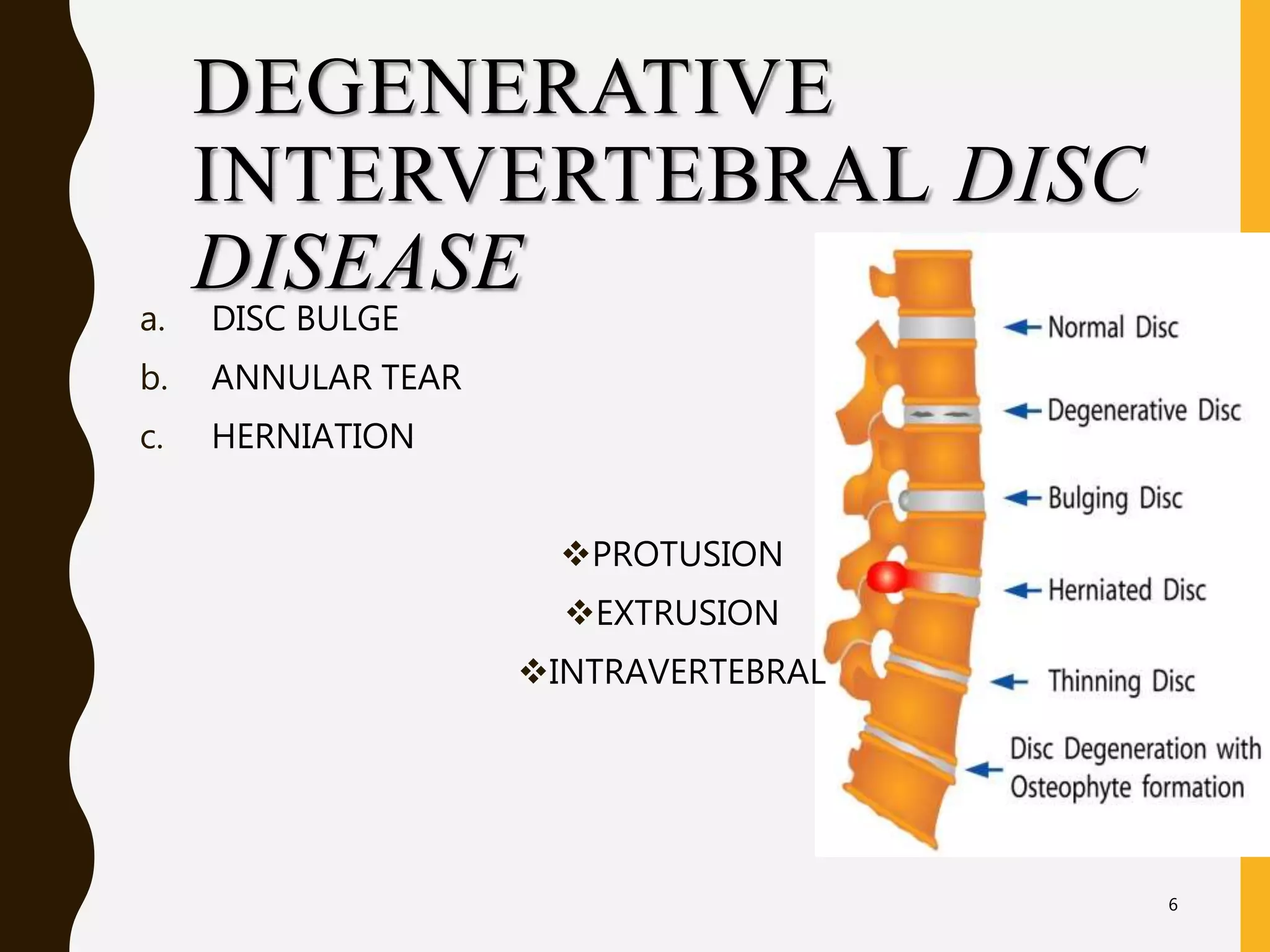 Degenerative disc disease (DDD) | PPTX