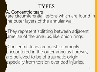 Degenerative disc disease (DDD) | PPTX