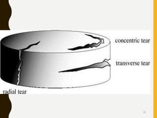 Degenerative disc disease (DDD) | PPTX
