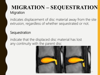 Degenerative disc disease (DDD) | PPTX