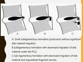 Degenerative disc disease (DDD) | PPTX