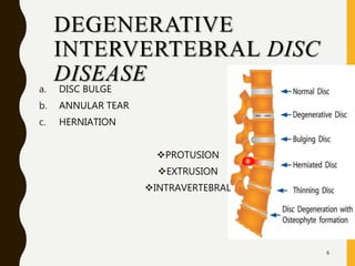 Degenerative disc disease (DDD) | PPTX