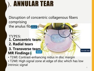 Degenerative disc disease (DDD) | PPTX