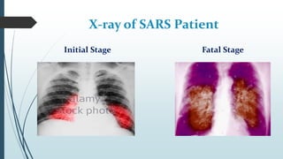 Severe Acute Respiratory Syndrome (SARS) | PPTX