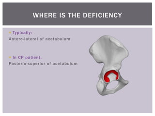 DDH Developmental Dislocation of Hip | PPT