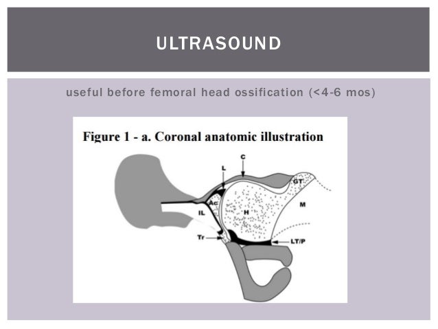 DDH Developmental Dislocation of Hip