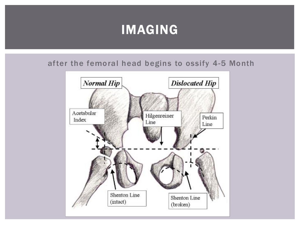 DDH Developmental Dislocation of Hip