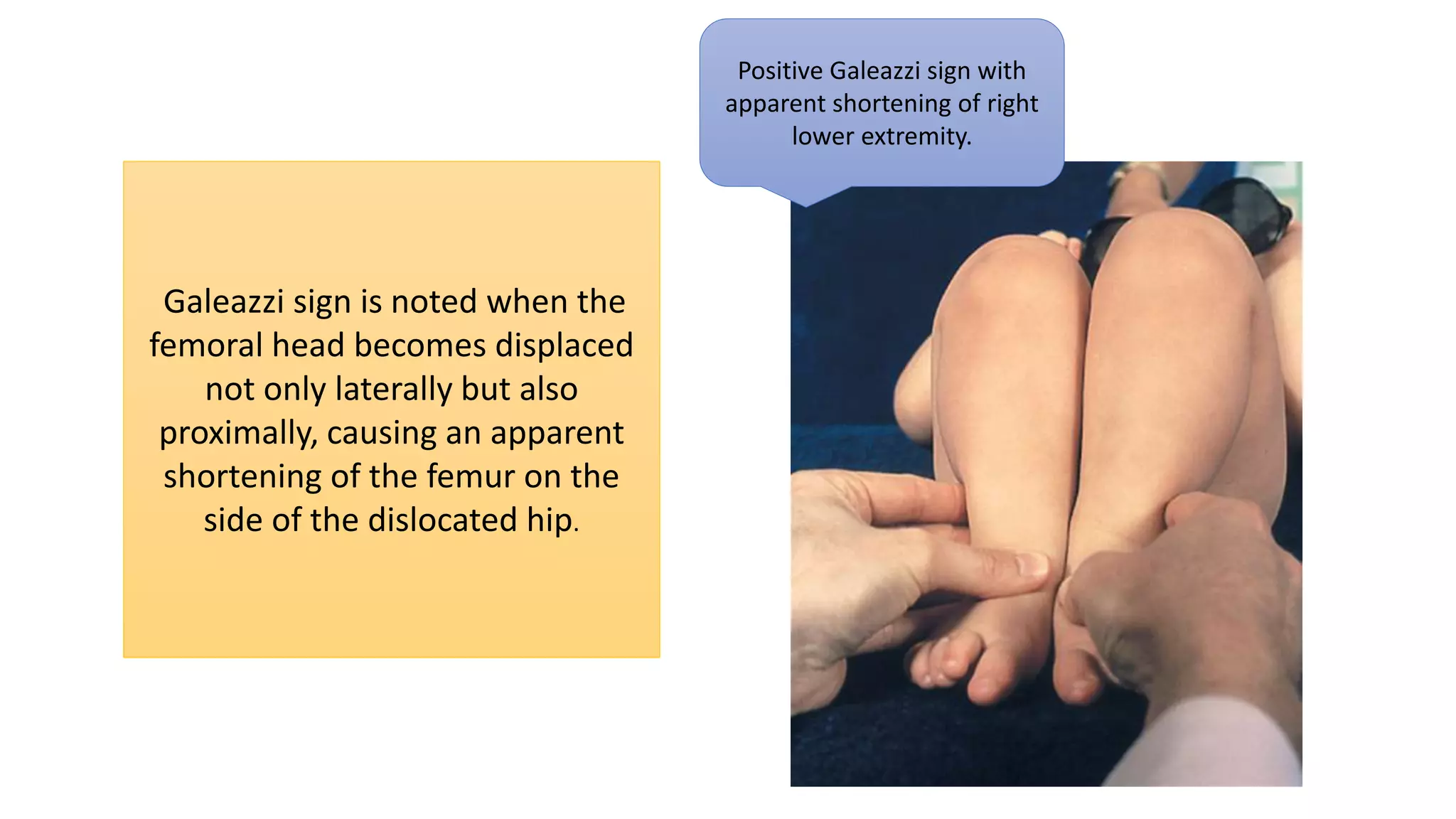 Developmental dysplasia of hip | PPTX
