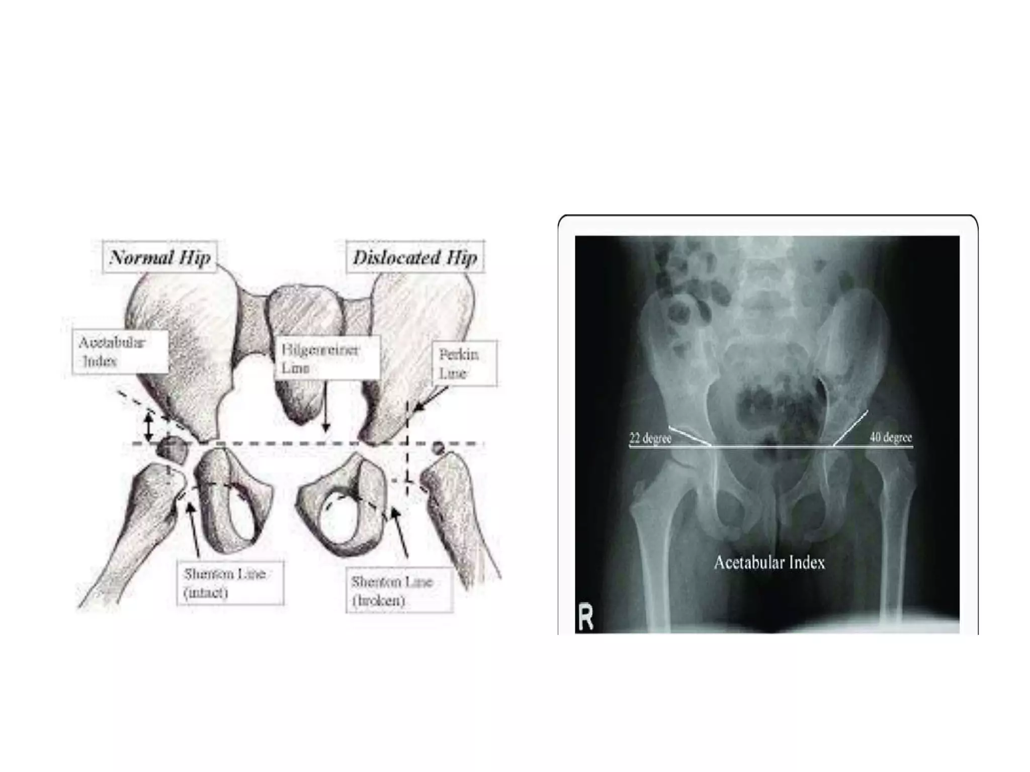 Developmental dysplasia of hip Ddh | PPTX | Pregnancy | Reproductive Health