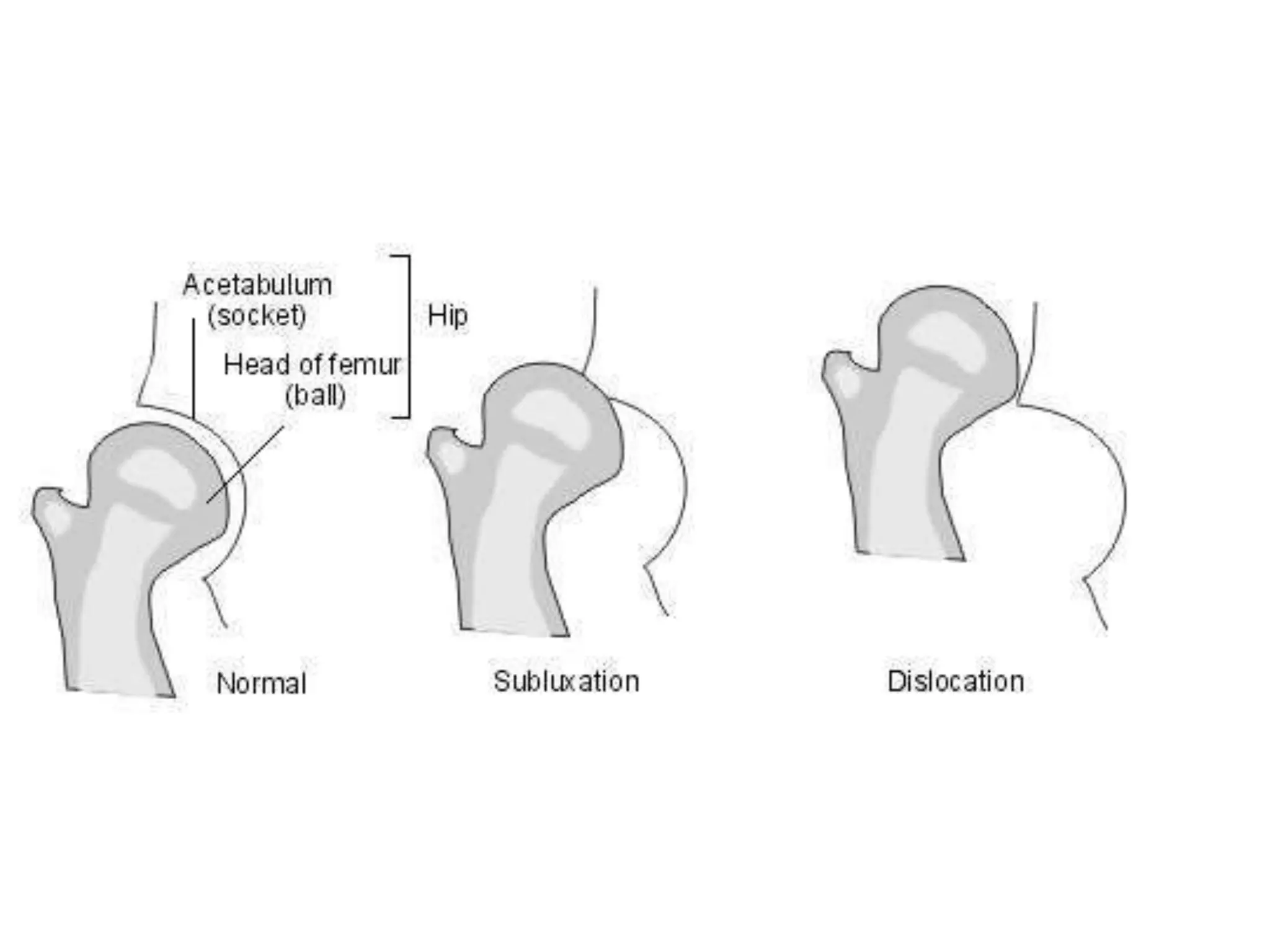 Developmental dysplasia of hip Ddh | PPTX