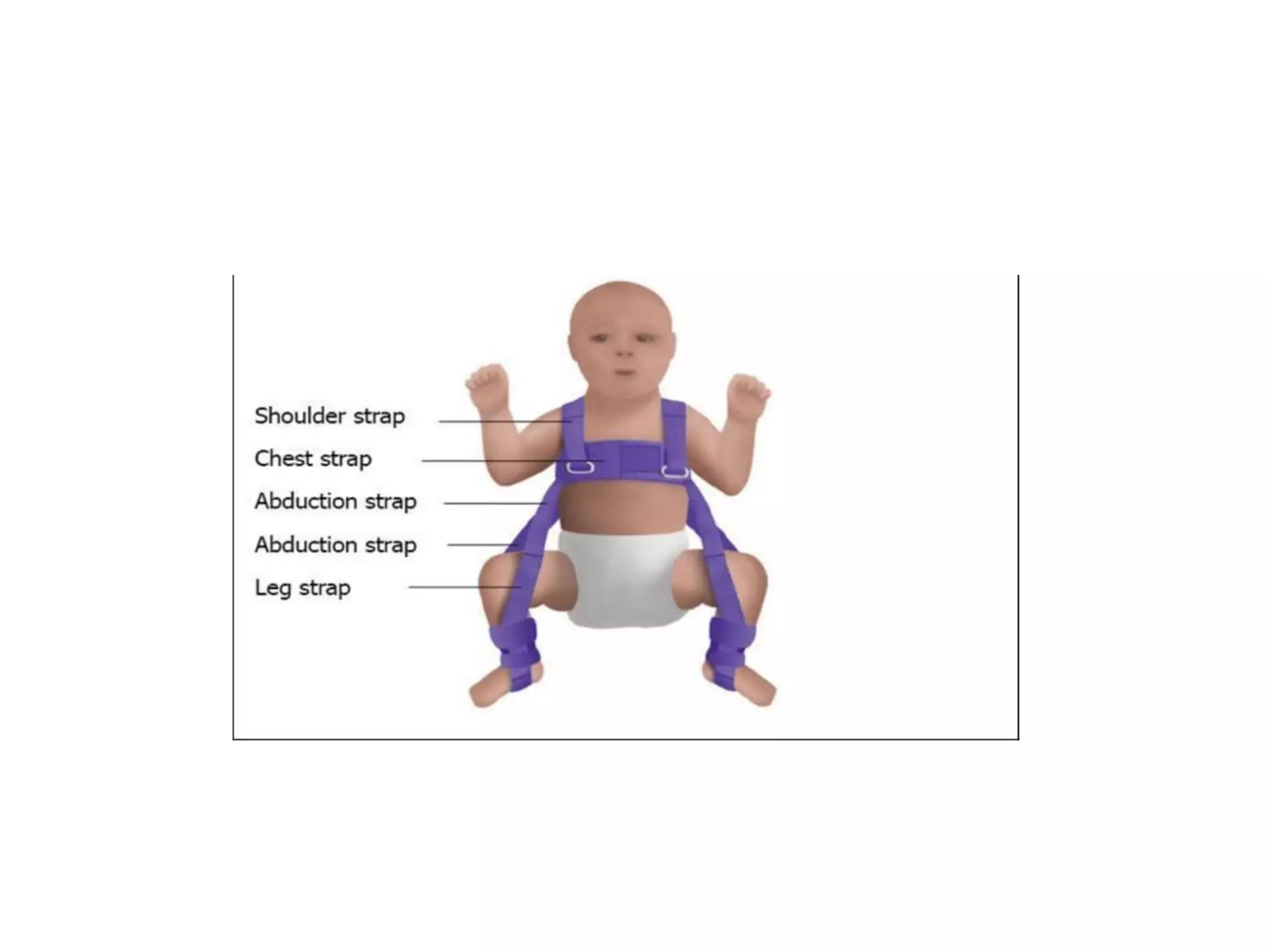 Developmental dysplasia of hip Ddh | PPTX
