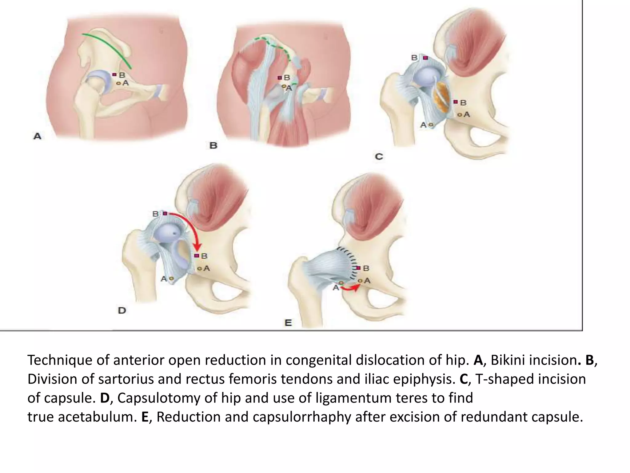 Developmental dysplasia of hip Ddh | PPTX | Pregnancy | Reproductive Health