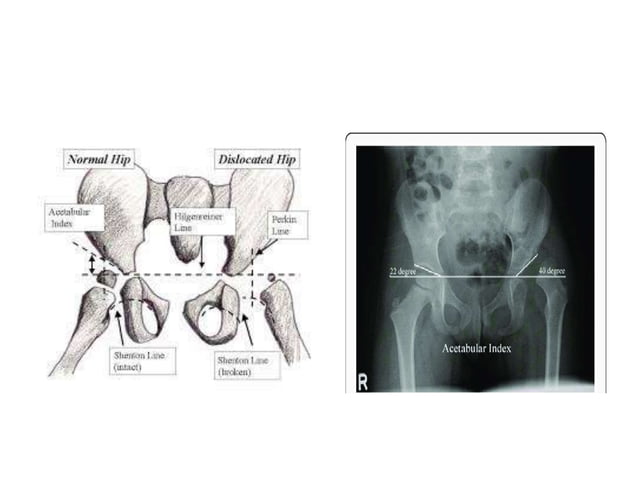 Developmental dysplasia of hip Ddh | PPTX | Pregnancy | Reproductive Health