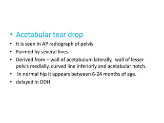 Developmental dysplasia of hip Ddh | PPTX