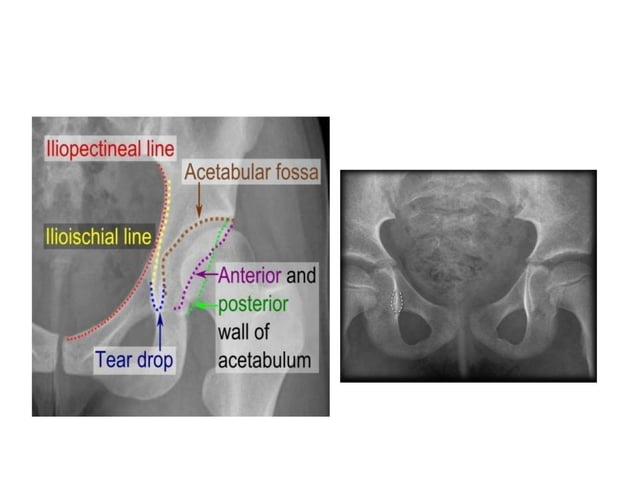 Developmental dysplasia of hip Ddh | PPTX | Pregnancy | Reproductive Health