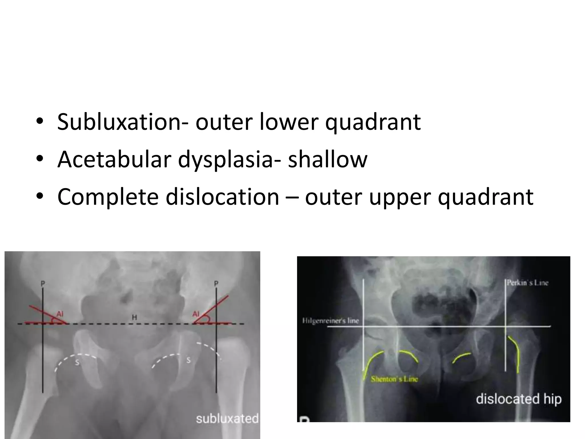 Developmental Dysplasia Hip | PPTX