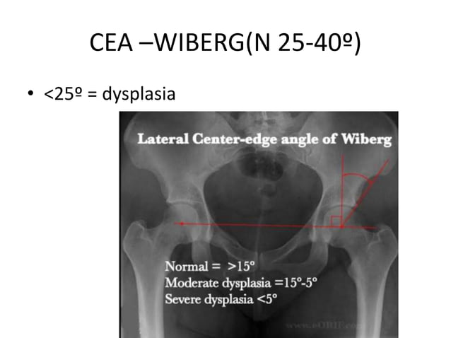 Developmental Dysplasia Hip | PPT