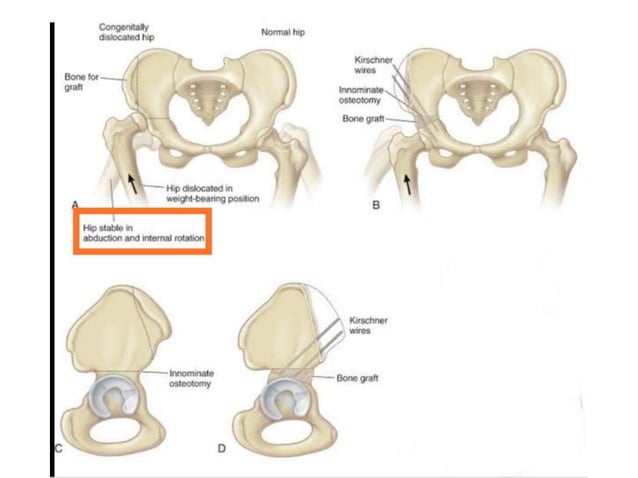 Developmental Dysplasia Hip | PPT