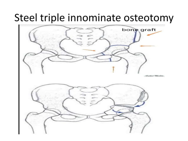 Developmental Dysplasia Hip | PPT