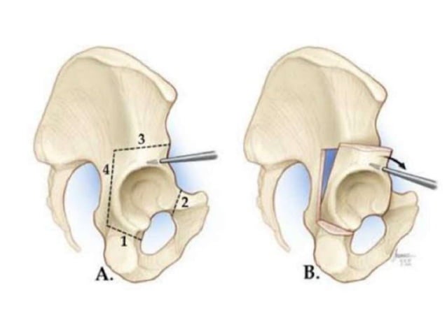 Developmental Dysplasia Hip | PPT
