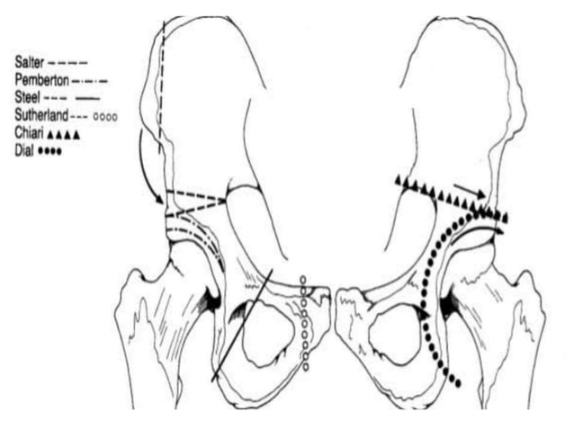 Developmental Dysplasia Hip | PPT