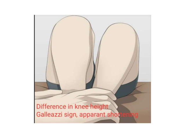 Developmental Dysplasia Hip | PPT