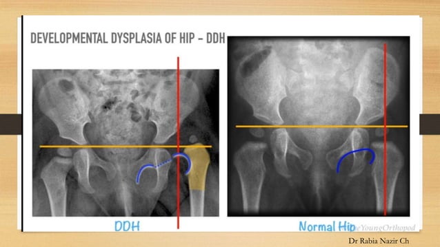 Developmental dysplasia of hip Radiology | PPTX