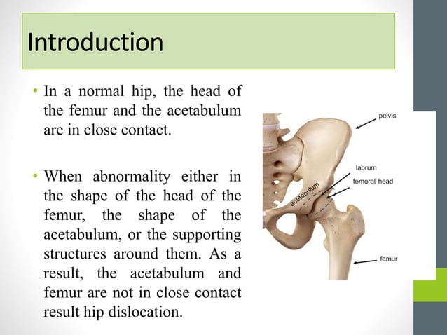 Developmental Dysplasia Of Hip Or Displacement Of Hip | PPT