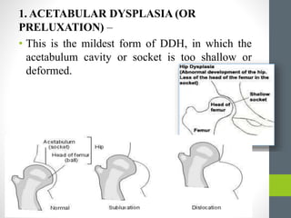 Developmental Dysplasia Of Hip Or Displacement Of Hip | PPT
