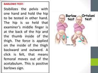 Newborn Ortolani Sign On
