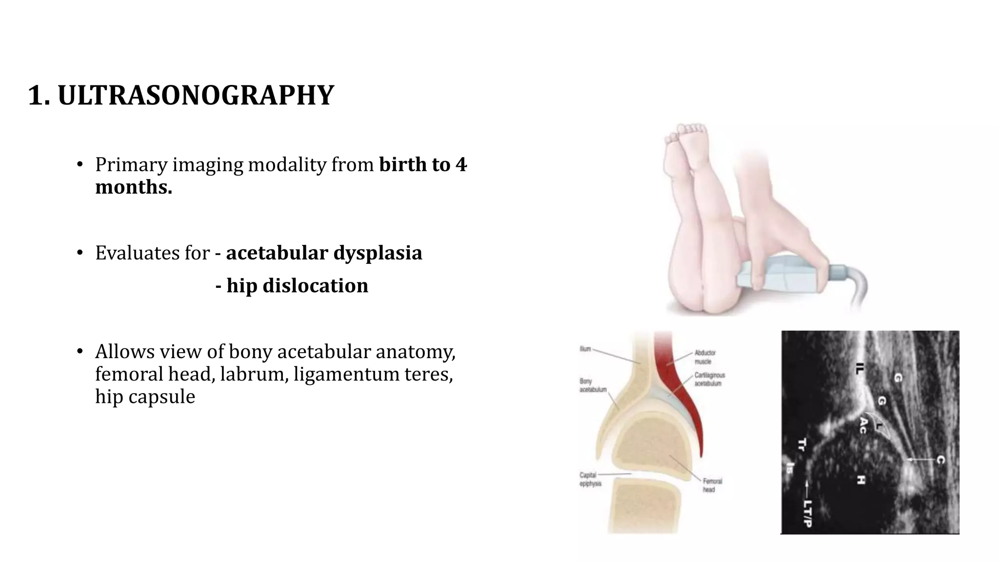 DDH (Developmental Dysplasia of Hip).pptx