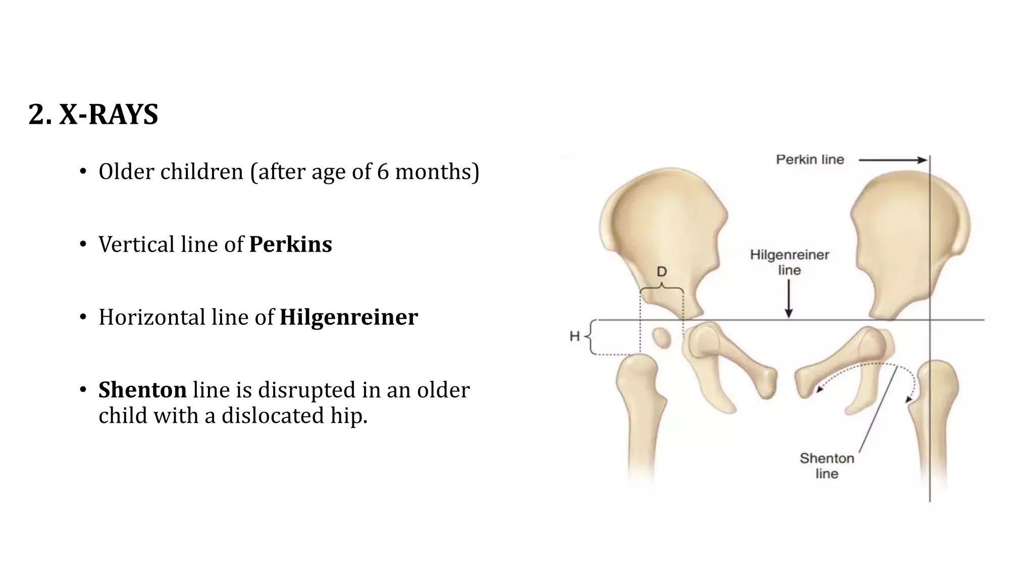 DDH (Developmental Dysplasia of Hip).pptx