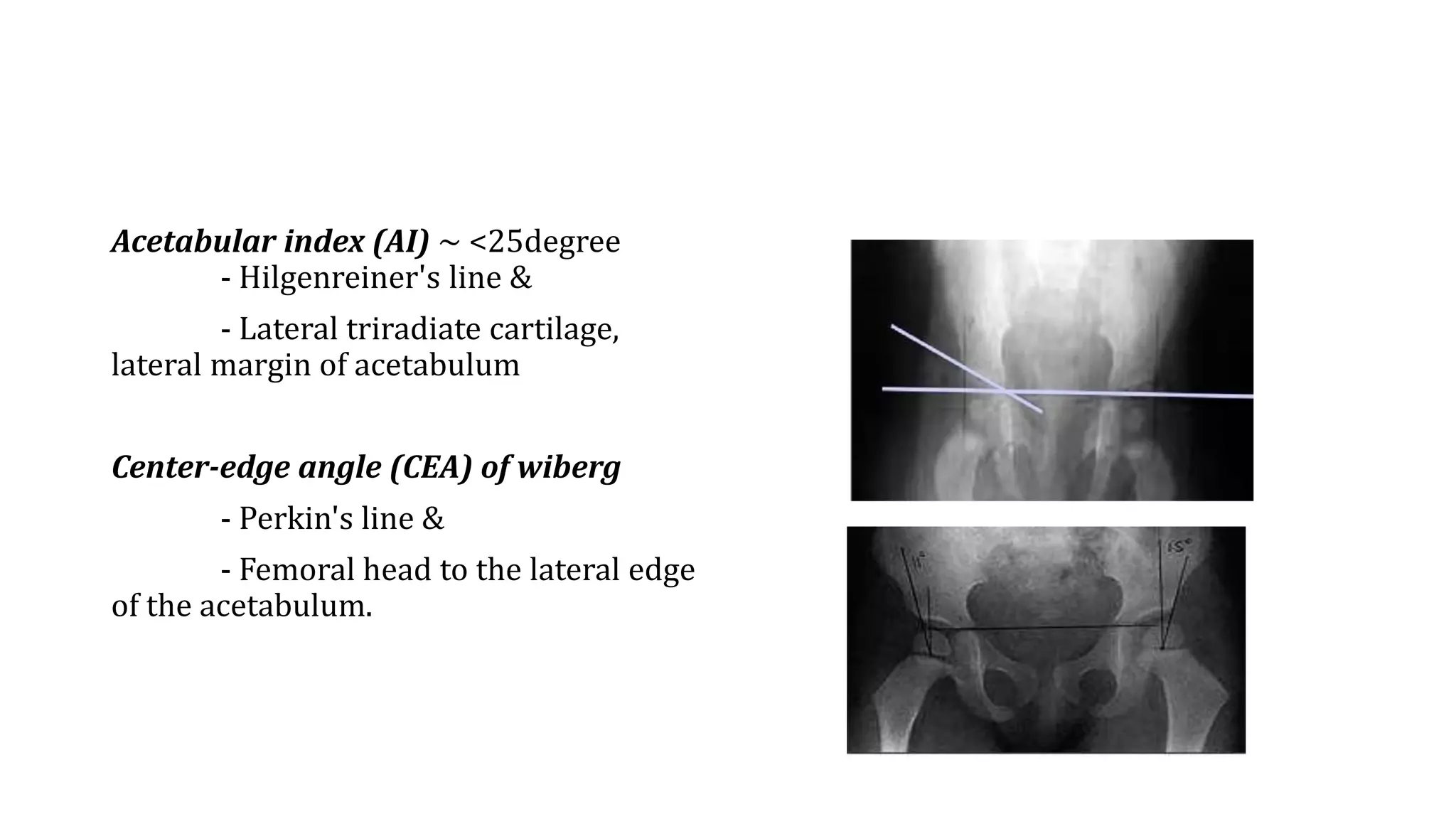 DDH (Developmental Dysplasia of Hip).pptx