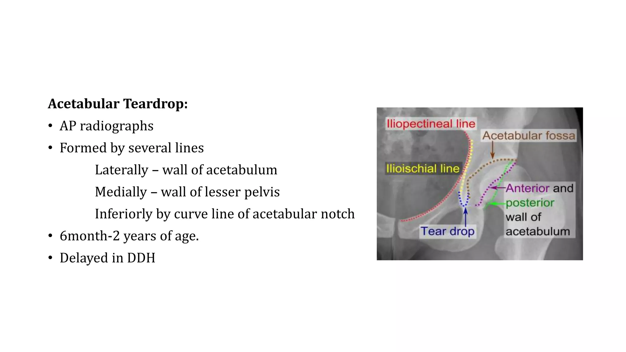 DDH (Developmental Dysplasia of Hip).pptx