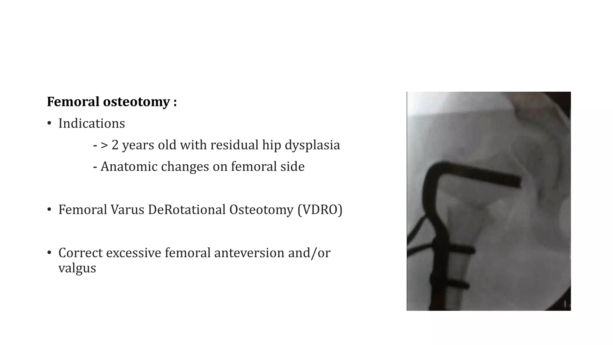 DDH (Developmental Dysplasia of Hip).pptx