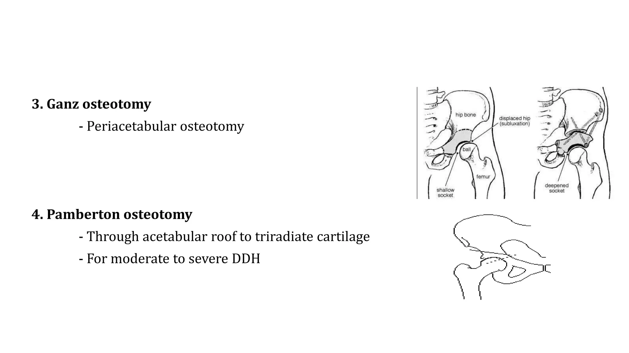 DDH (Developmental Dysplasia of Hip).pptx