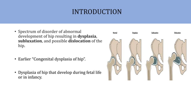 DDH (Developmental Dysplasia of Hip).pptx