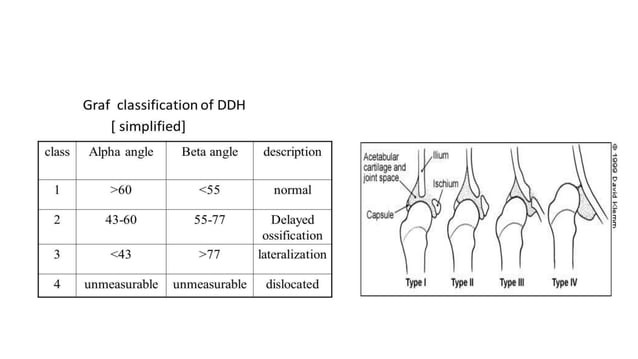 DDH (Developmental Dysplasia of Hip).pptx
