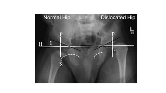 DDH (Developmental Dysplasia of Hip).pptx