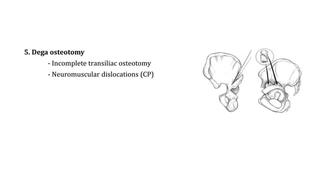 DDH (Developmental Dysplasia of Hip).pptx